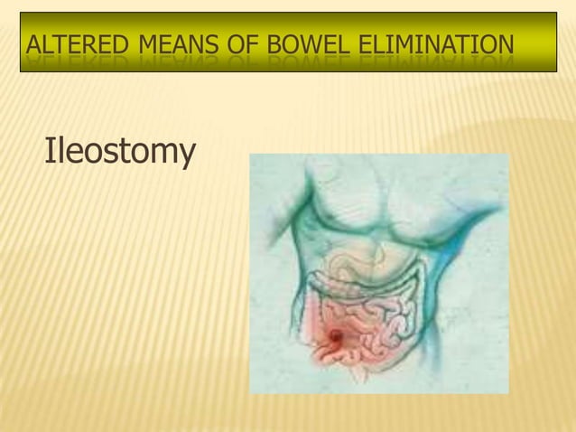 53 a focus 9 elimination | PPT