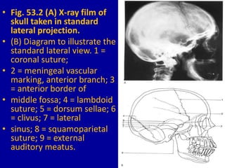 External Auditory Meatus X Ray