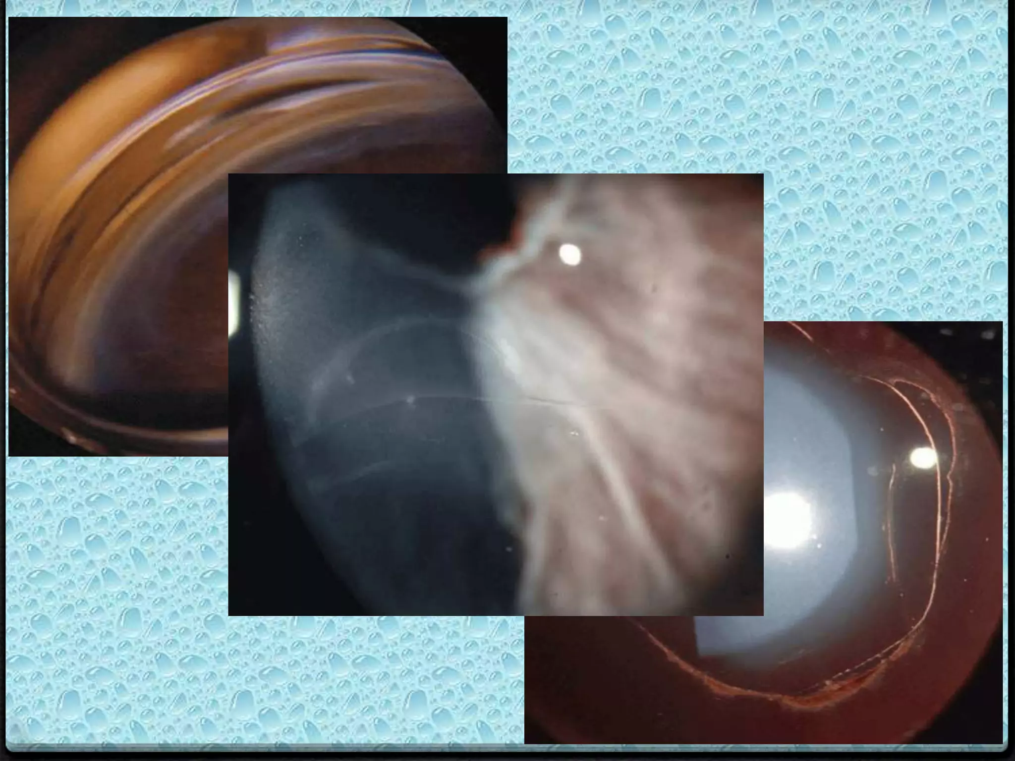 congenital glaucoma part 1 | PPTX