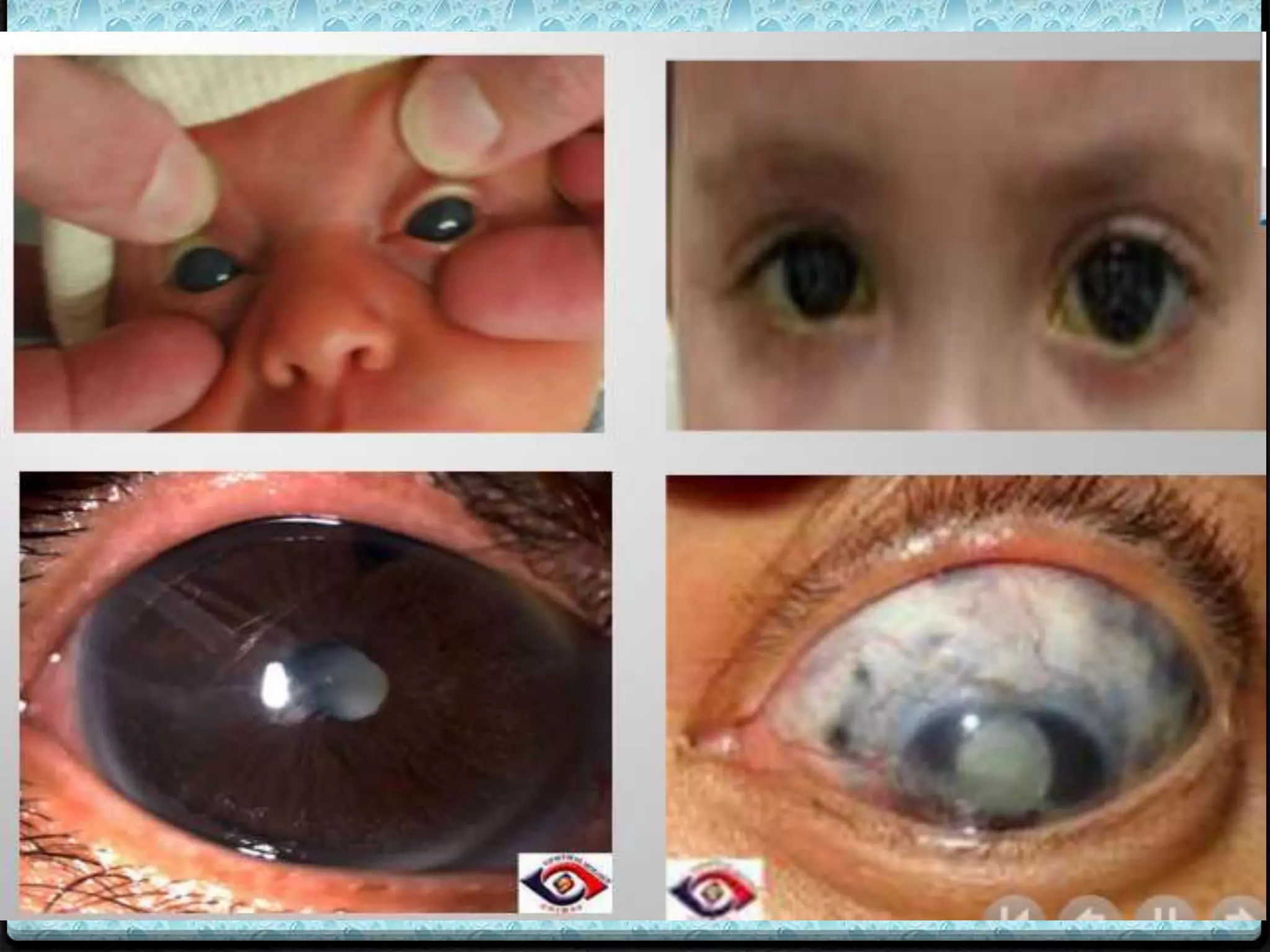 congenital glaucoma part 1 | PPTX