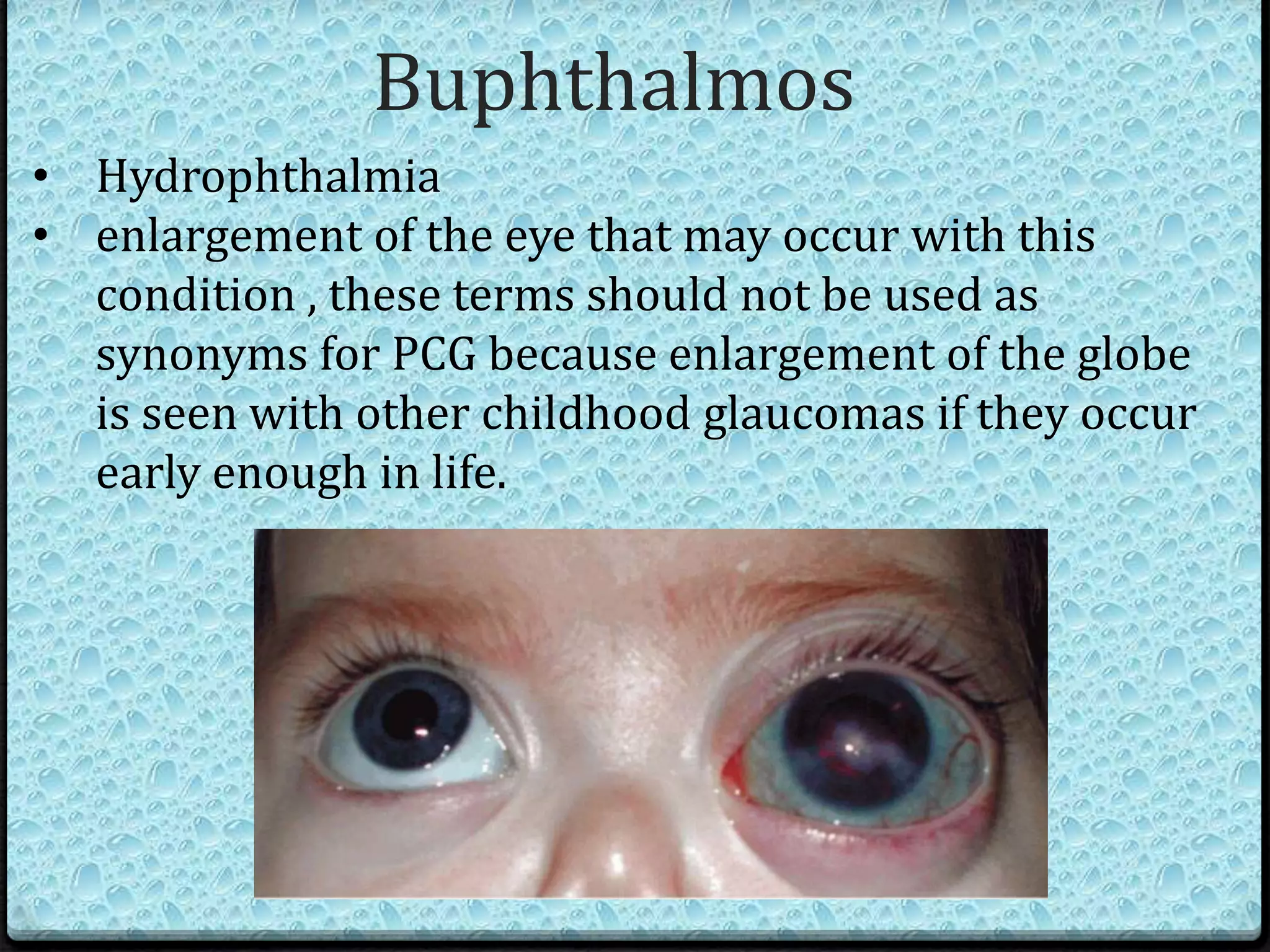 congenital glaucoma part 1 | PPTX