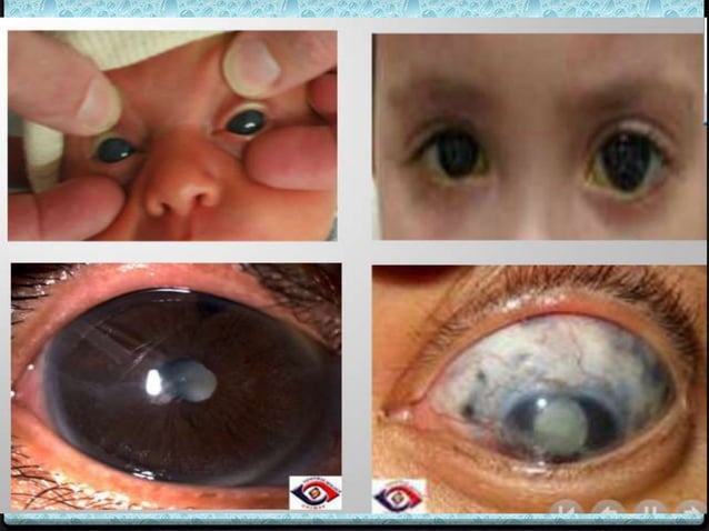 congenital glaucoma part 1 | PPTX