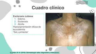 54-Esclerosis Sistémica Progresiva (3).pptx