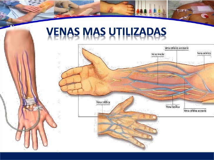 Cuidados de enfermería en accesos venosos - CICAT-SALUD