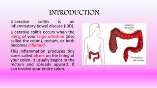 Nutrition in Ulcerative Colitis | PPTX