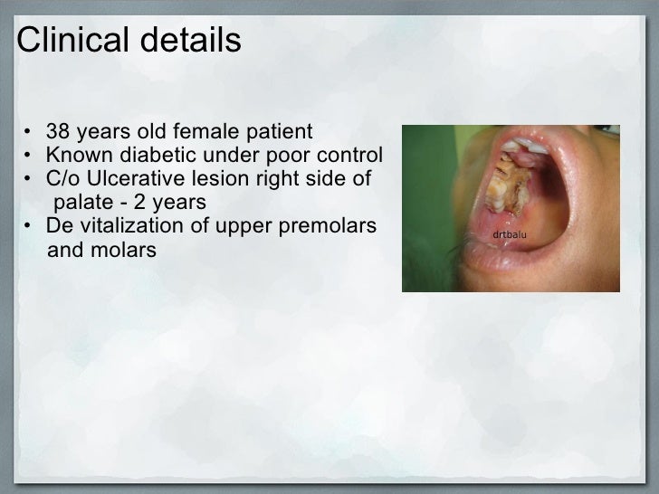 Invasive Rhinomaxillary Mucormycosis a case report