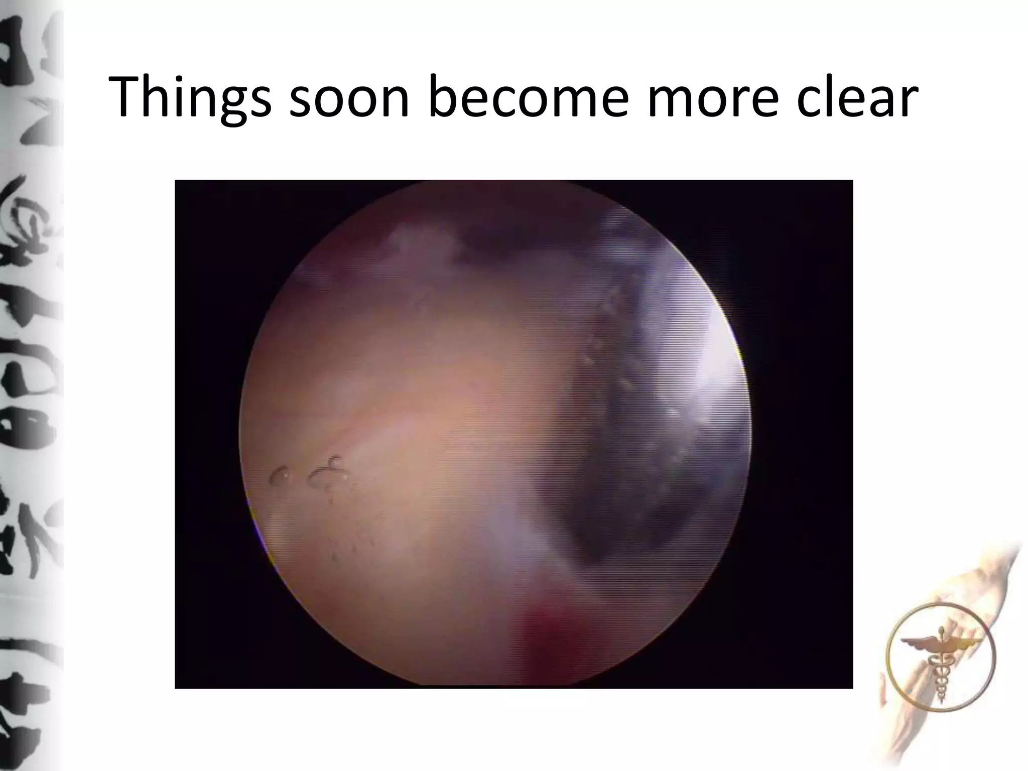 Technique of bursectomy | PPTX