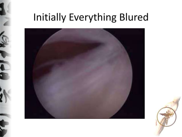 Technique of bursectomy | PPTX