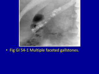 54 gallbladder and bile duct calcification | PPT
