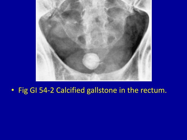 54 gallbladder and bile duct calcification | PPTX