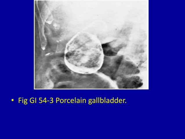 54 gallbladder and bile duct calcification | PPTX