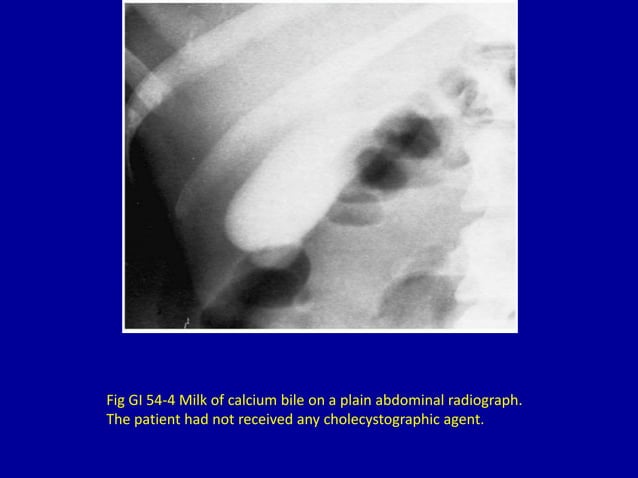 54 gallbladder and bile duct calcification | PPTX