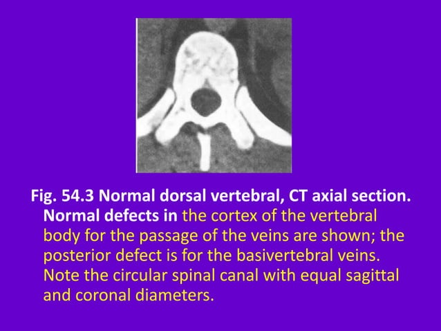 54 DAVID SUTTON PICTURES NEURORADIOLOGY OF SPINE | PPTX