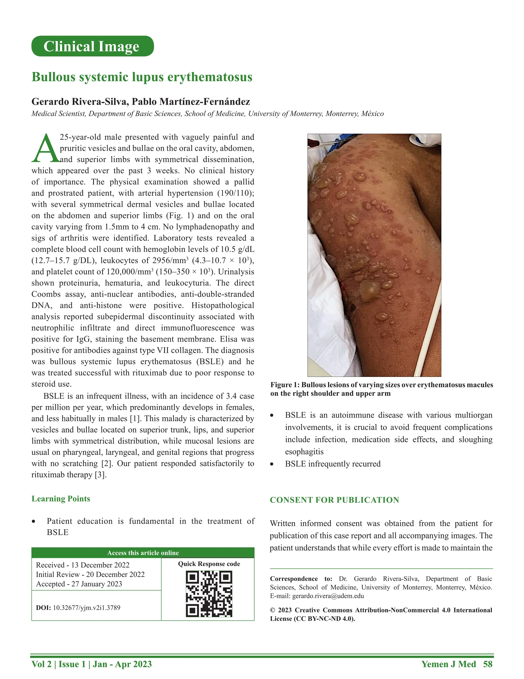 Clinical Image - Bullous systemic lupus erythematosus | PDF