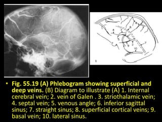 55 DAVID SUTTON PICTURES VASCULAR IMAGING IN NEURORADIOLOGY | PPT