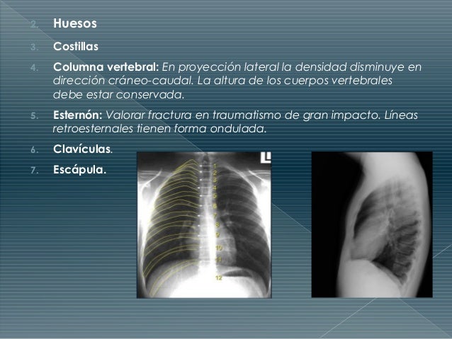 Radiología Torácica
