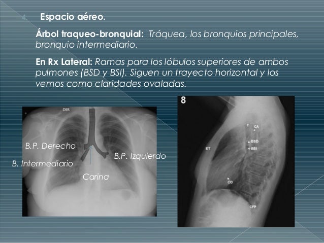 Radiología Torácica