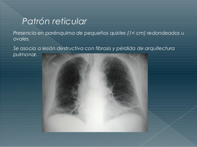 Tac Torax Patron Nodular