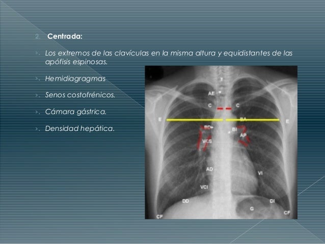 Radiología Torácica
