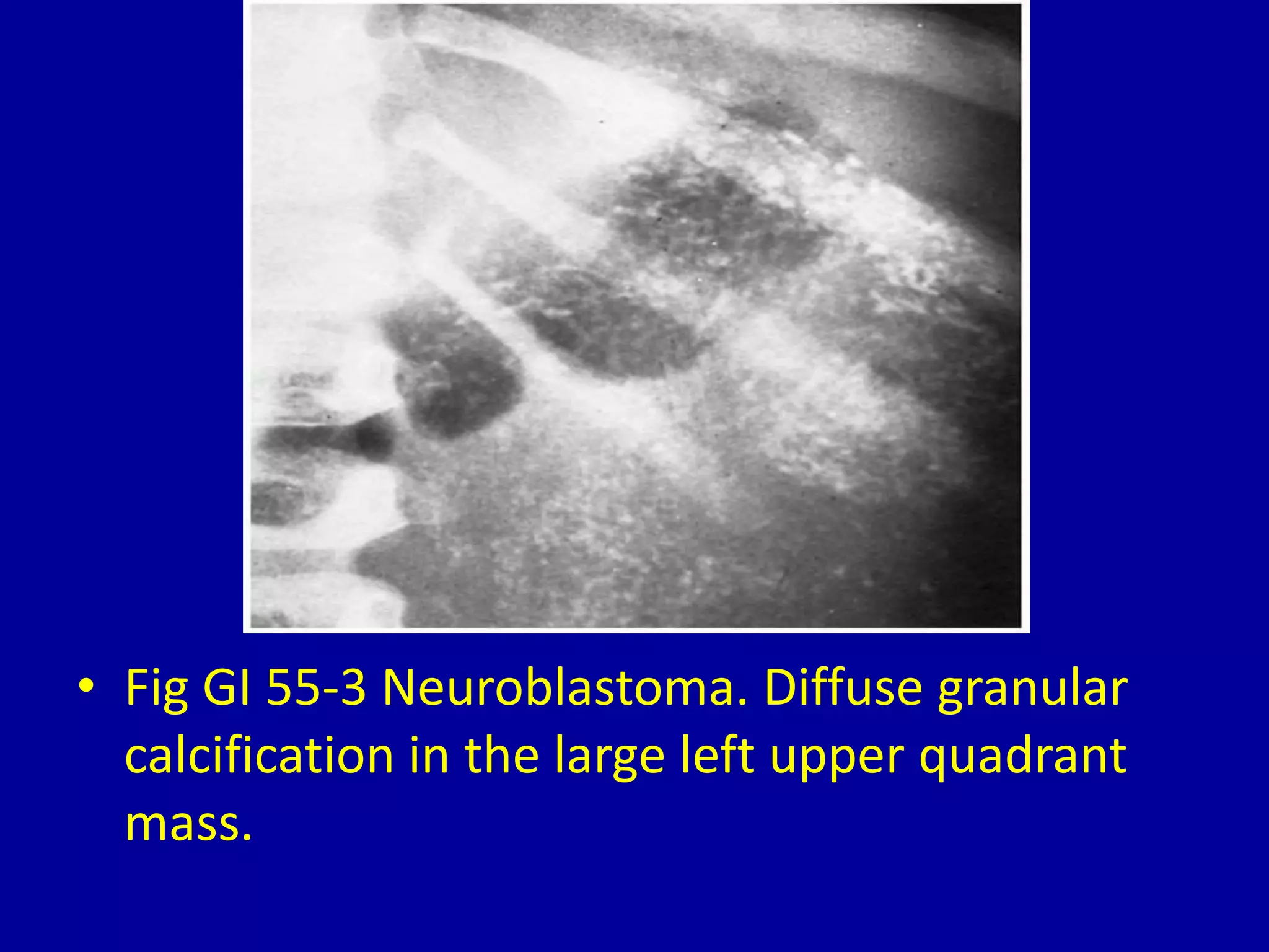 55 adrenal calcification | PPTX