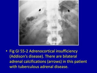 55 adrenal calcification | PPTX