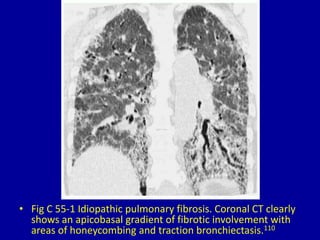 55 basilar predominant disease | PPTX | Lung and Respiratory Health ...