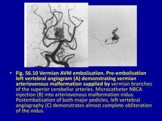 56 DAVID SUTTON PICTURES INTERVENTIONAL NEURORADIOLOGY | PPTX