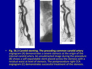 56 DAVID SUTTON PICTURES INTERVENTIONAL NEURORADIOLOGY | PPTX
