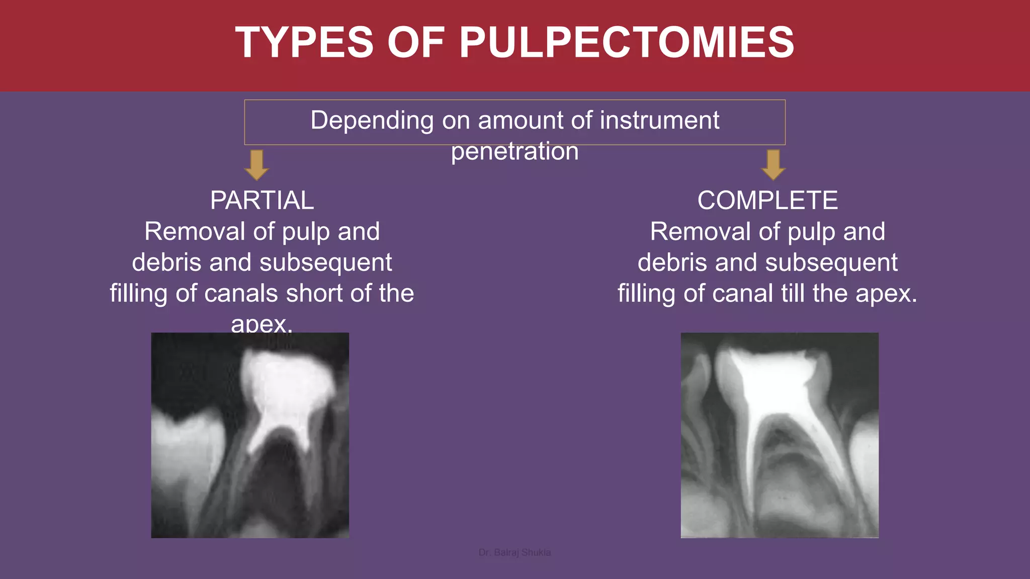Pulpectomy in Pediatric Dentistry | PPTX | Dental Health | Diseases and ...