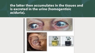 ALKAPTONURIA | PDF