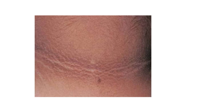 CUTANEOUS MANIFESTATIONS OF DM.pptx