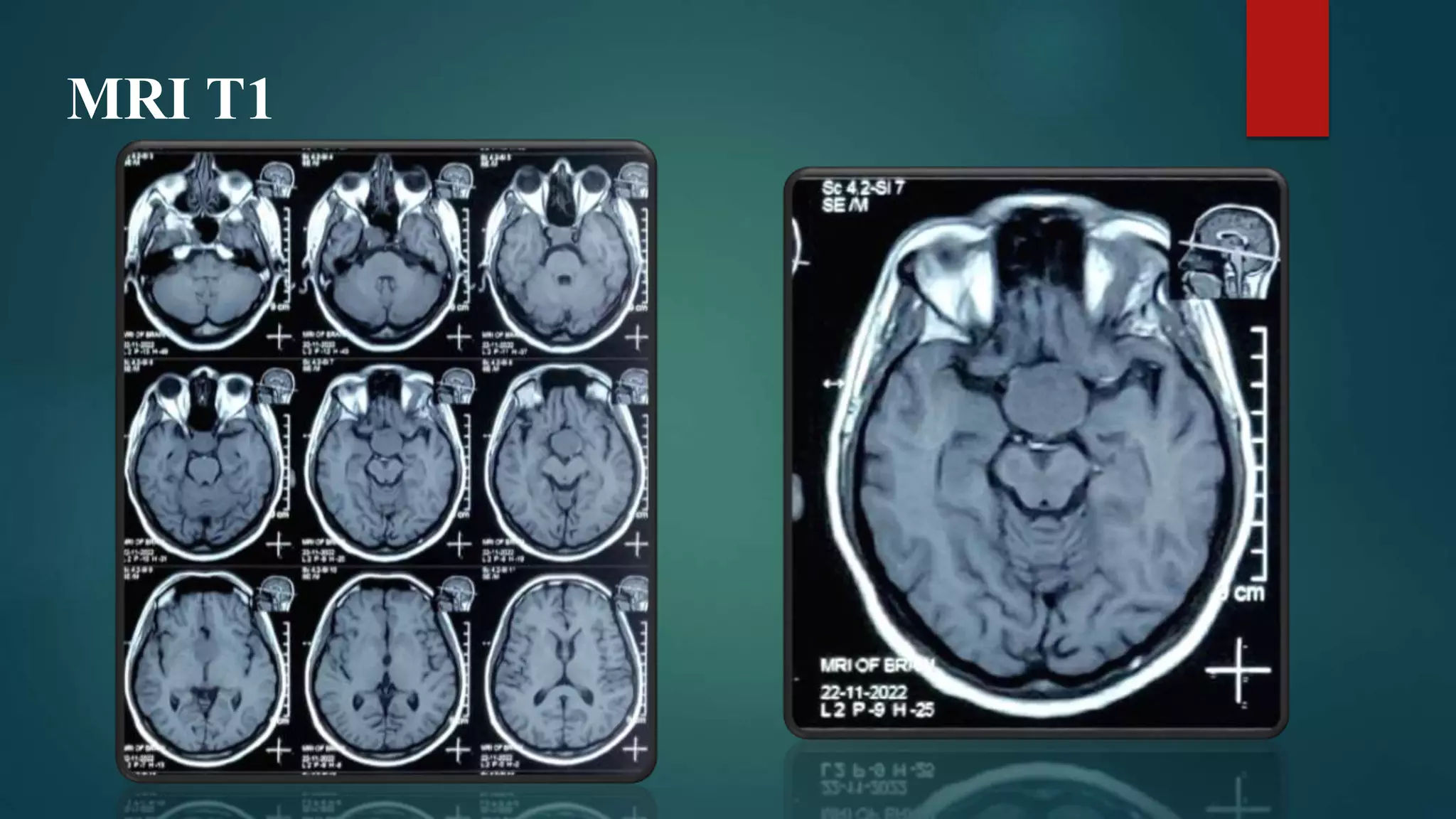 Pituitary Macroadenoma.pptx