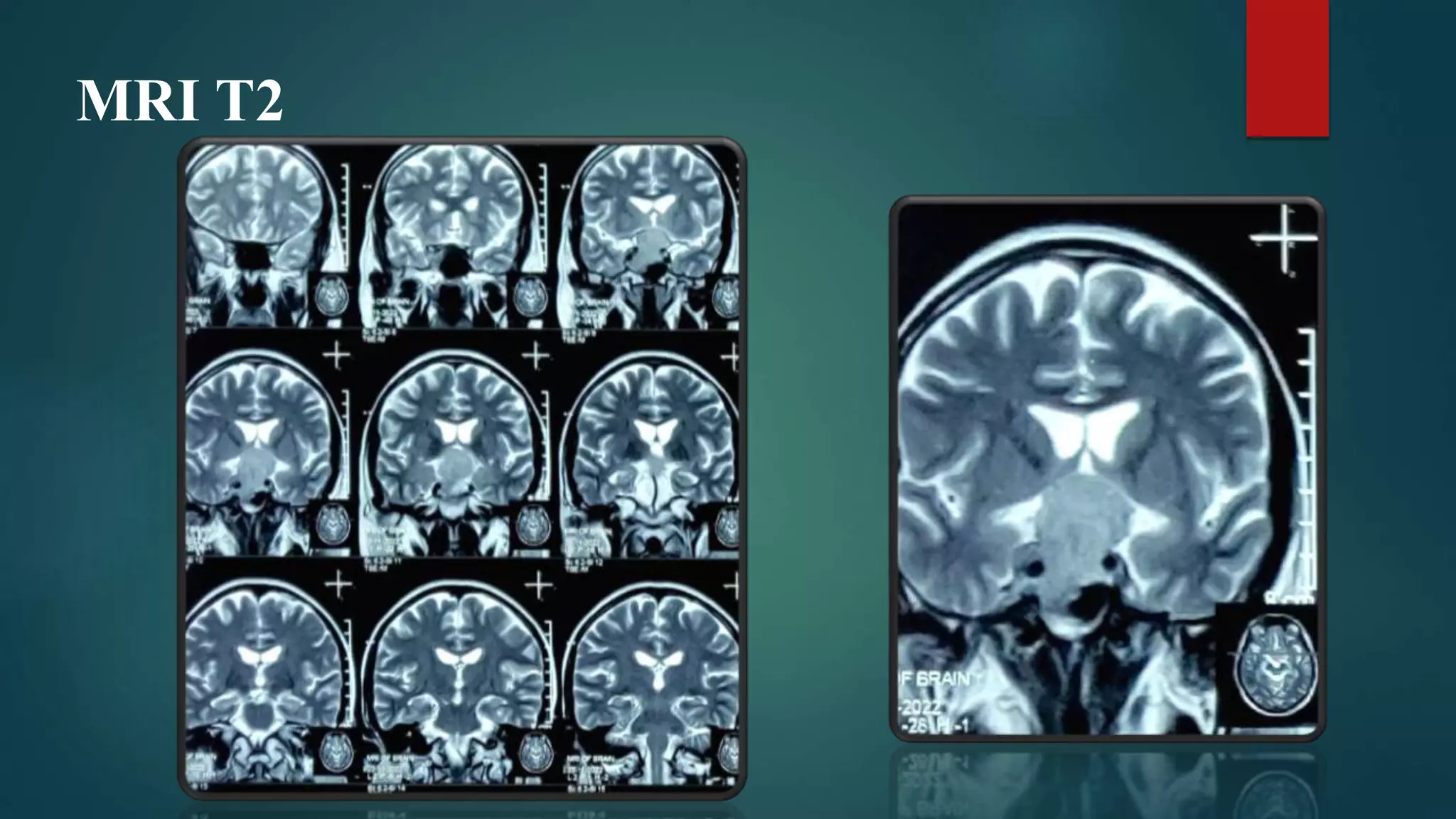 Pituitary Macroadenoma.pptx