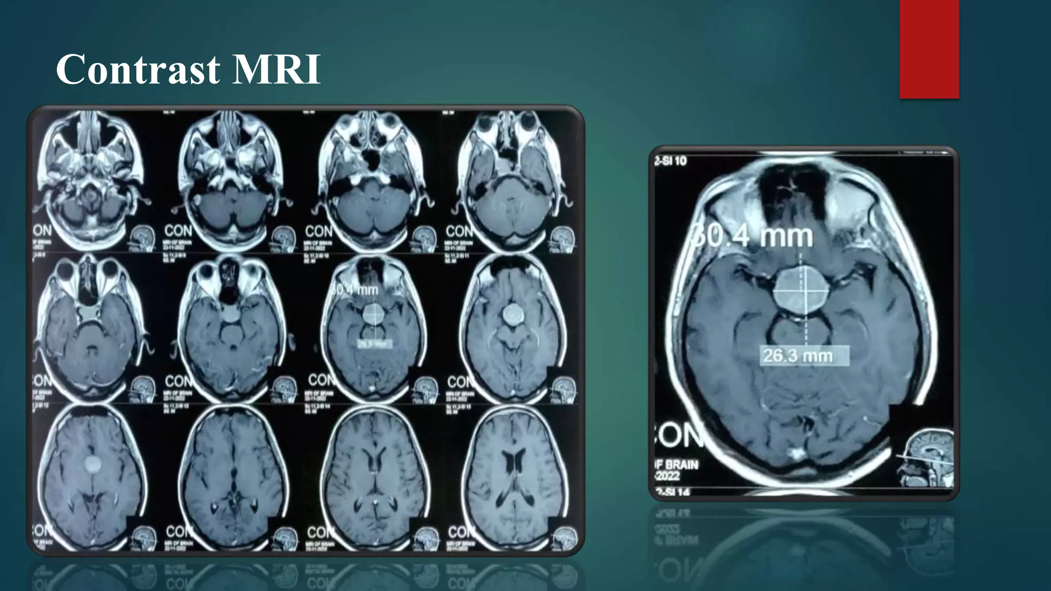 Pituitary Macroadenoma.pptx