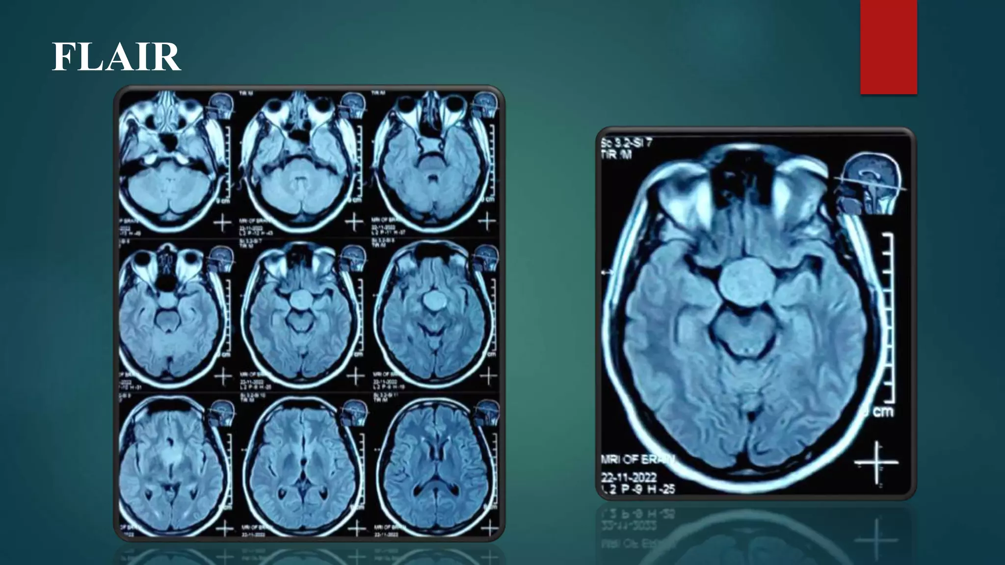 Pituitary Macroadenoma.pptx