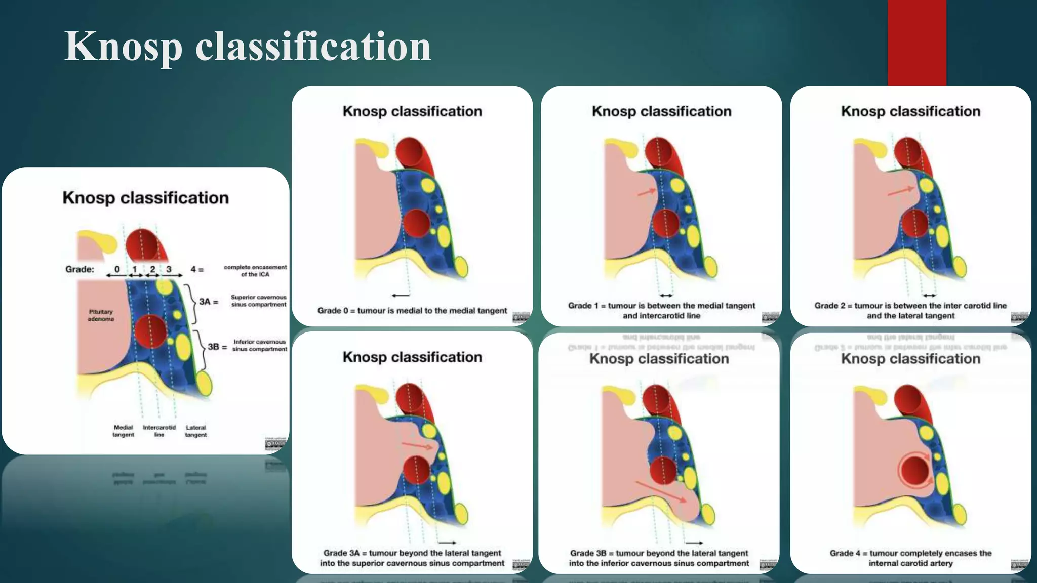 Pituitary Macroadenoma.pptx