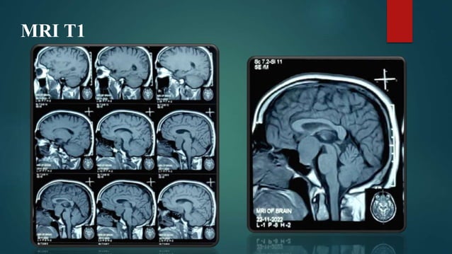 Pituitary Macroadenoma.pptx