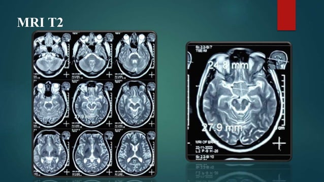 Pituitary Macroadenoma.pptx