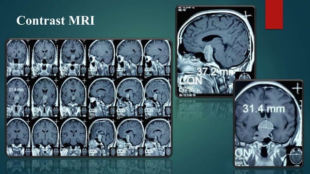 Pituitary Macroadenoma.pptx