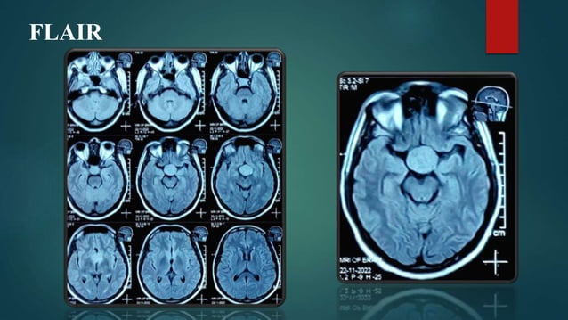 Pituitary Macroadenoma.pptx