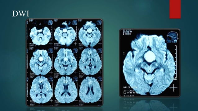 Pituitary Macroadenoma.pptx
