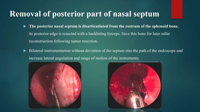 Pituitary Macroadenoma.pptx