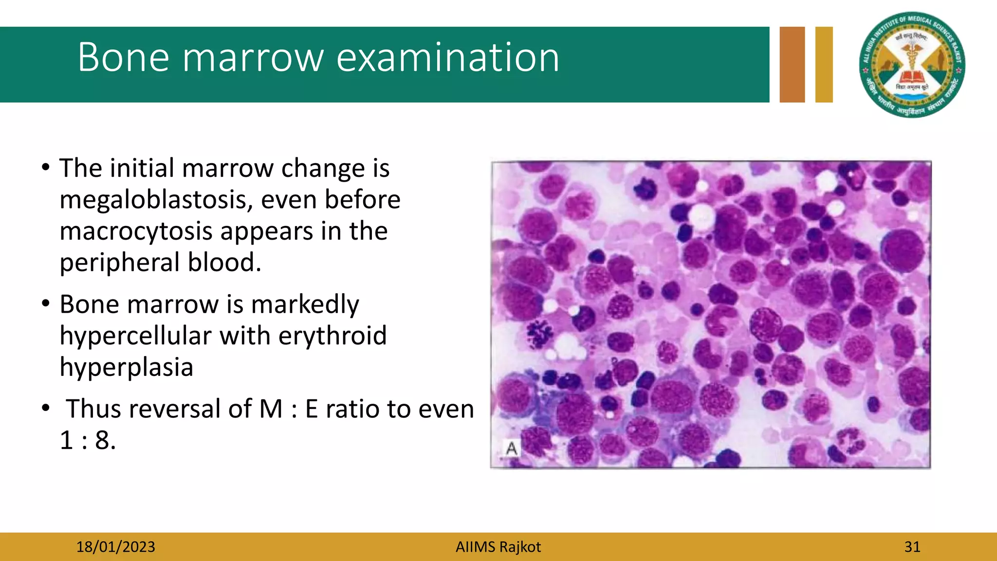 Macrocytic Anemia.pptx