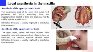 basic techniques of dental local anesthesia.pptx