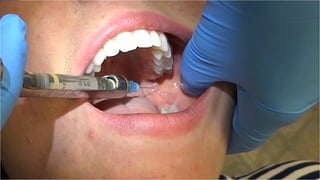 basic techniques of dental local anesthesia.pptx