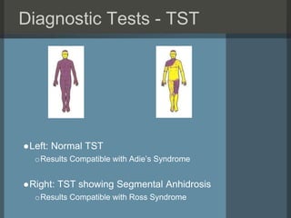 Adie’s Syndrome Focus Presentation.ppt