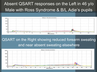 Adie’s Syndrome Focus Presentation.ppt
