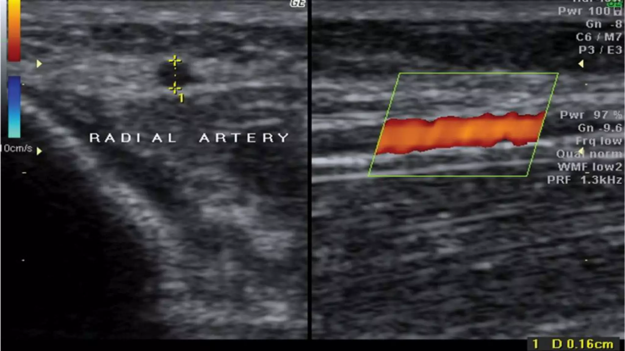 Role of USG in A-V fistula assessment | PPTX