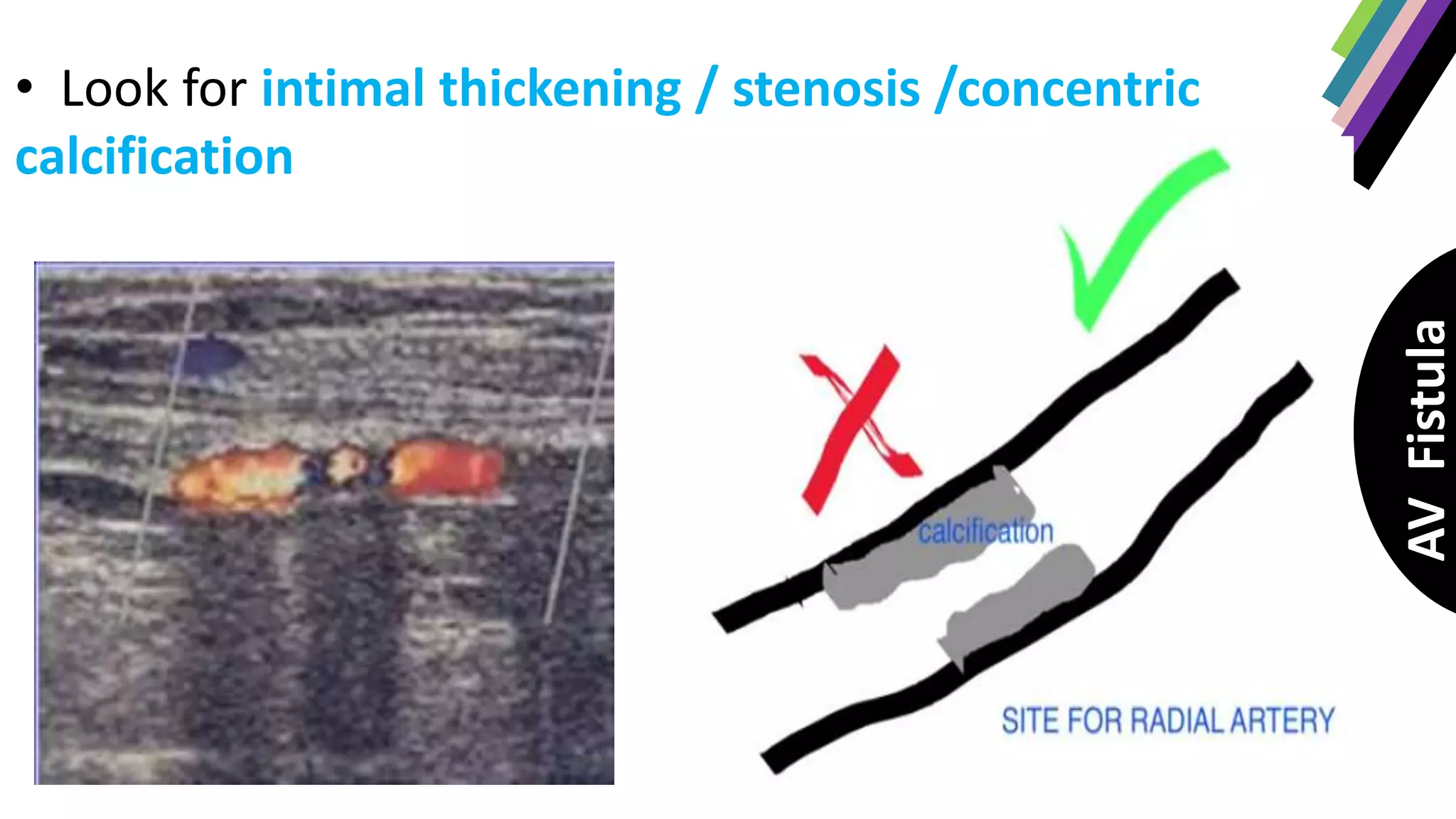 Role of USG in A-V fistula assessment | PPTX