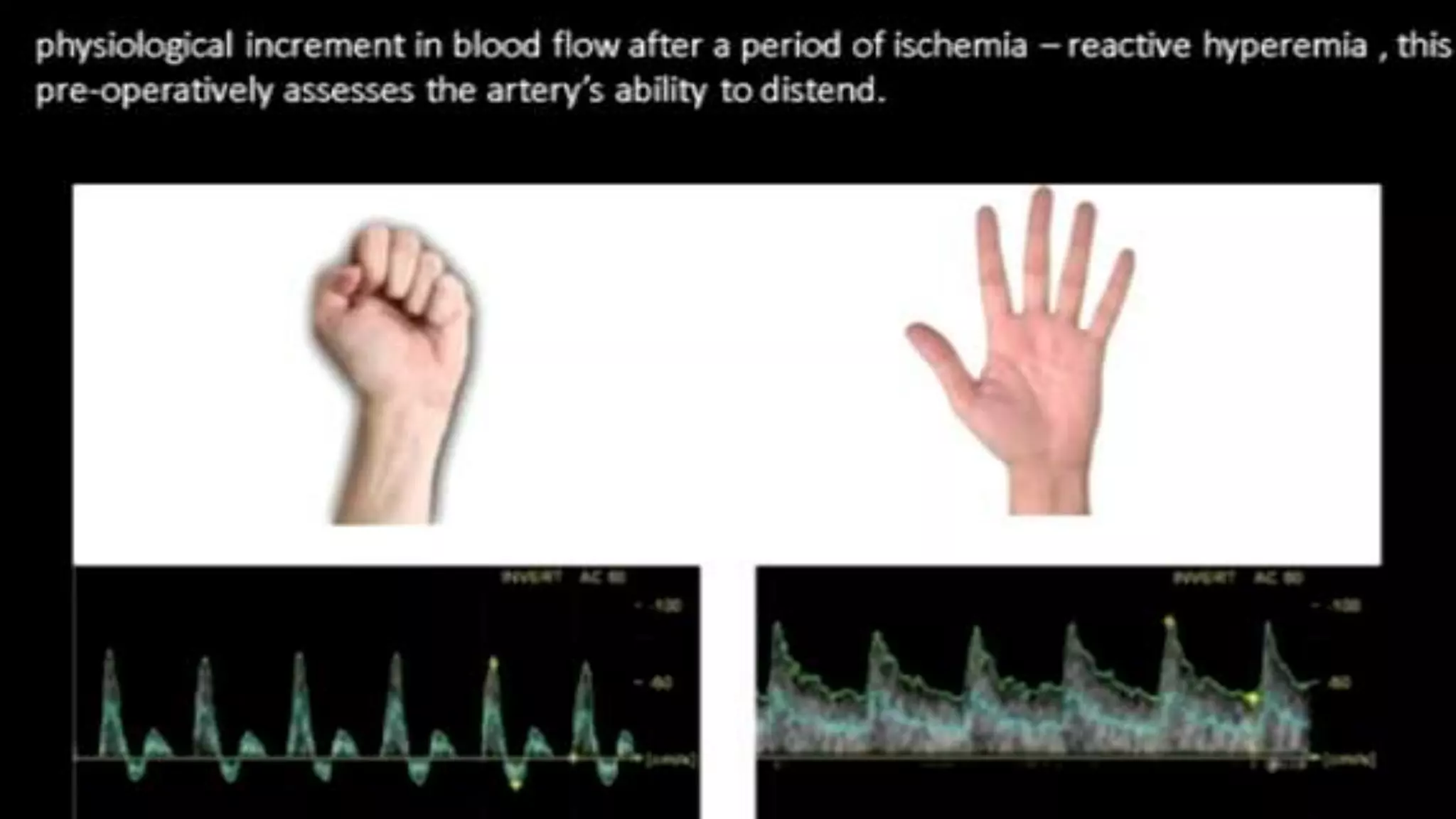 Role of USG in A-V fistula assessment | PPTX